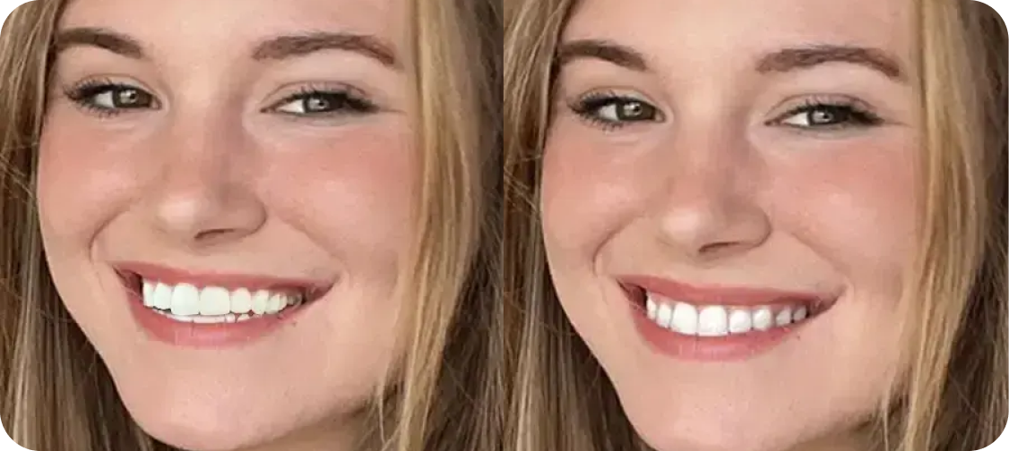 Clear Aligner Therapy for Adults - Center for Airway and Facial Development