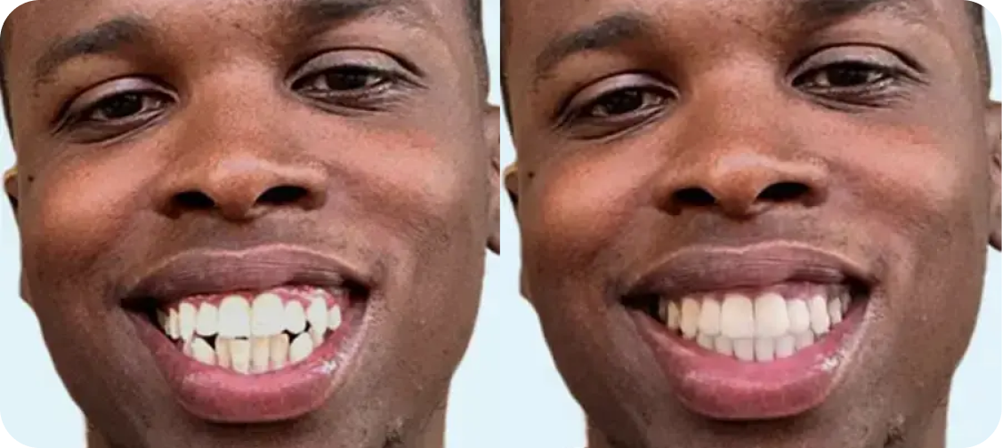 Clear Aligner Therapy for Adults - Center for Airway and Facial Development